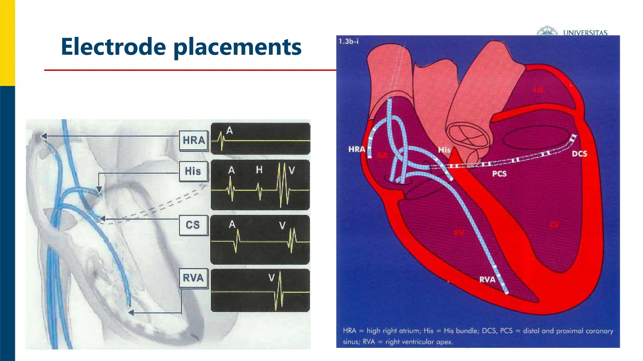 Basic Electrophysiology study and EGM material.pptx