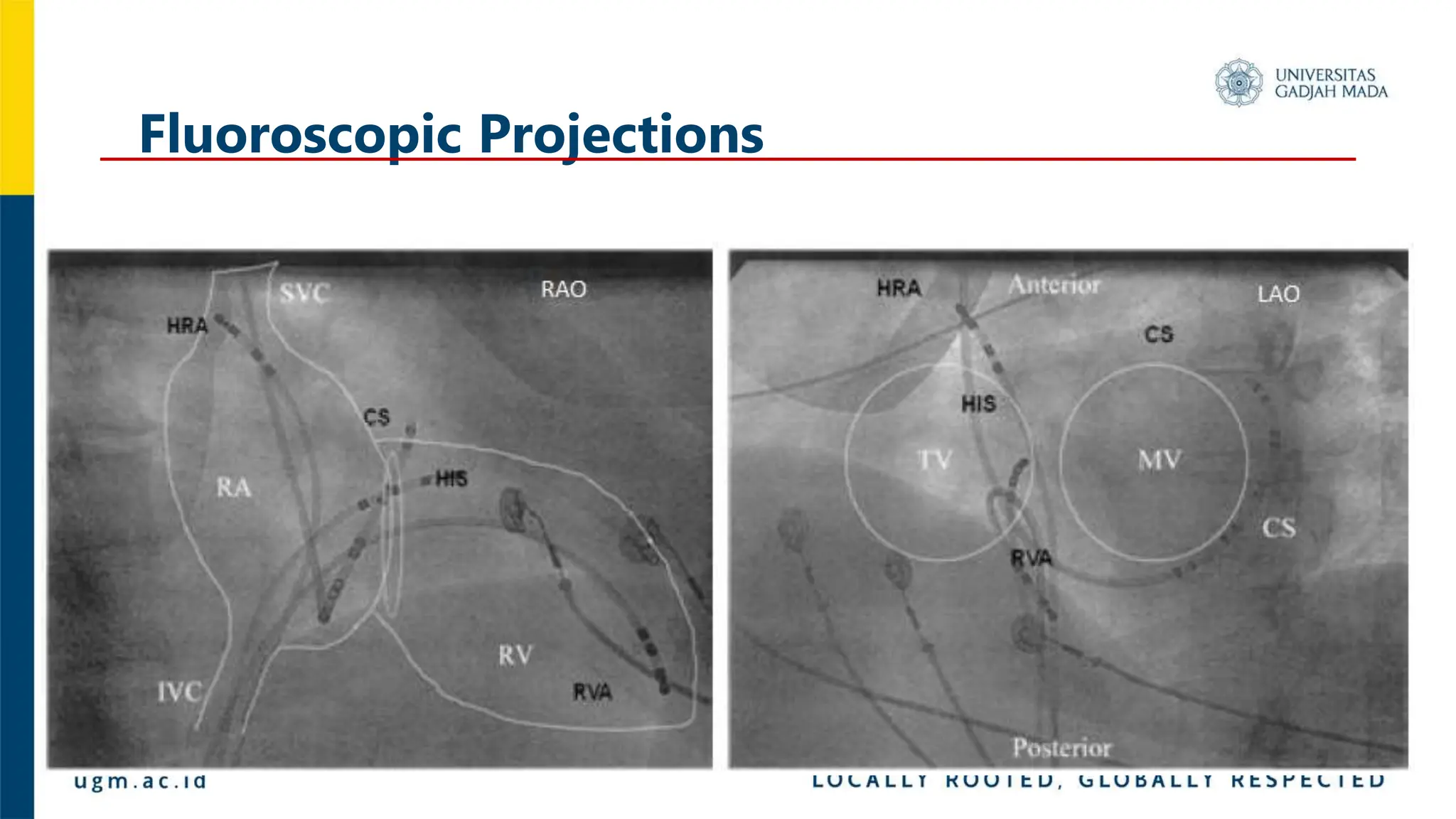 Basic Electrophysiology study and EGM material.pptx