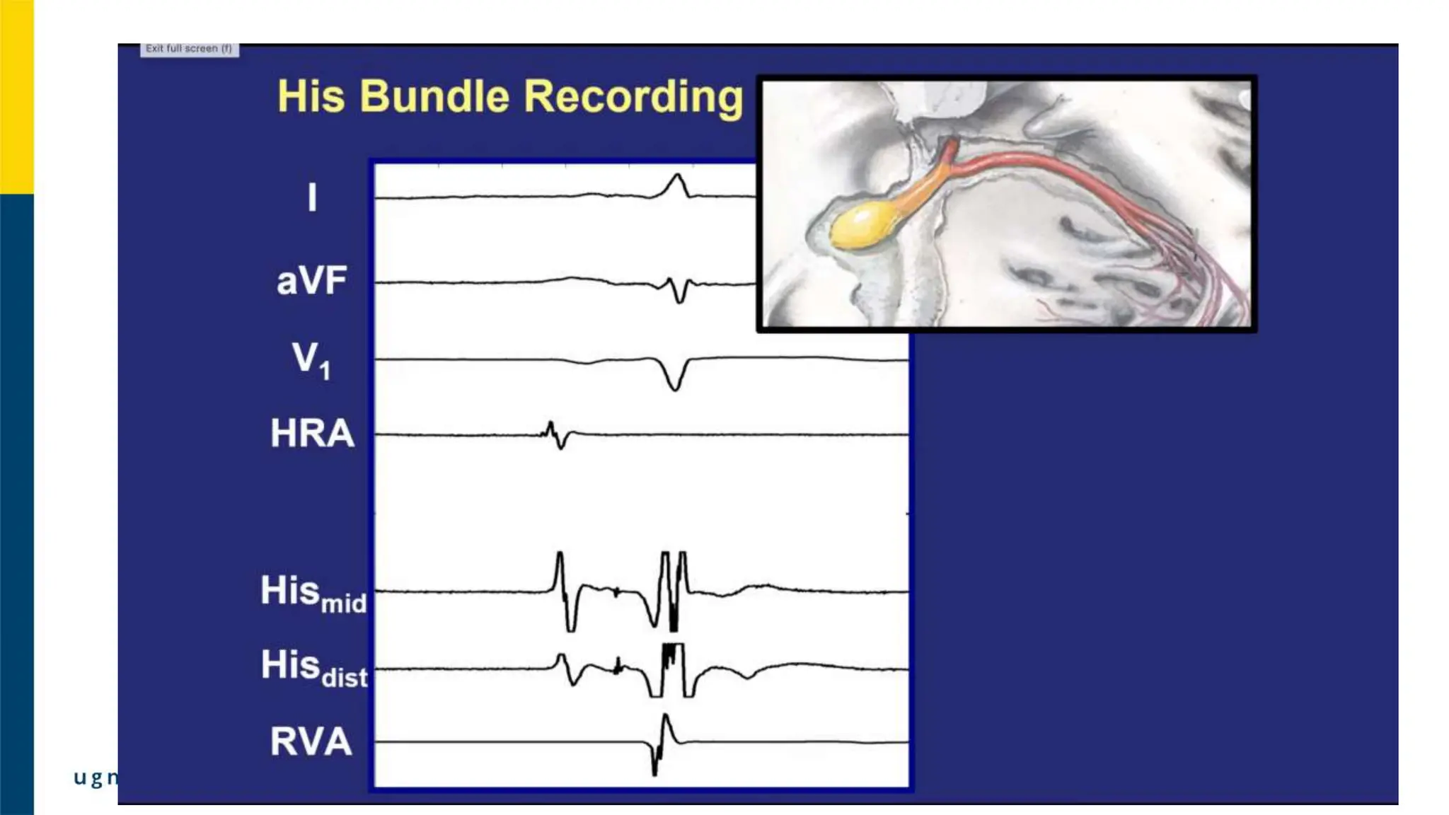 Basic Electrophysiology study and EGM material.pptx