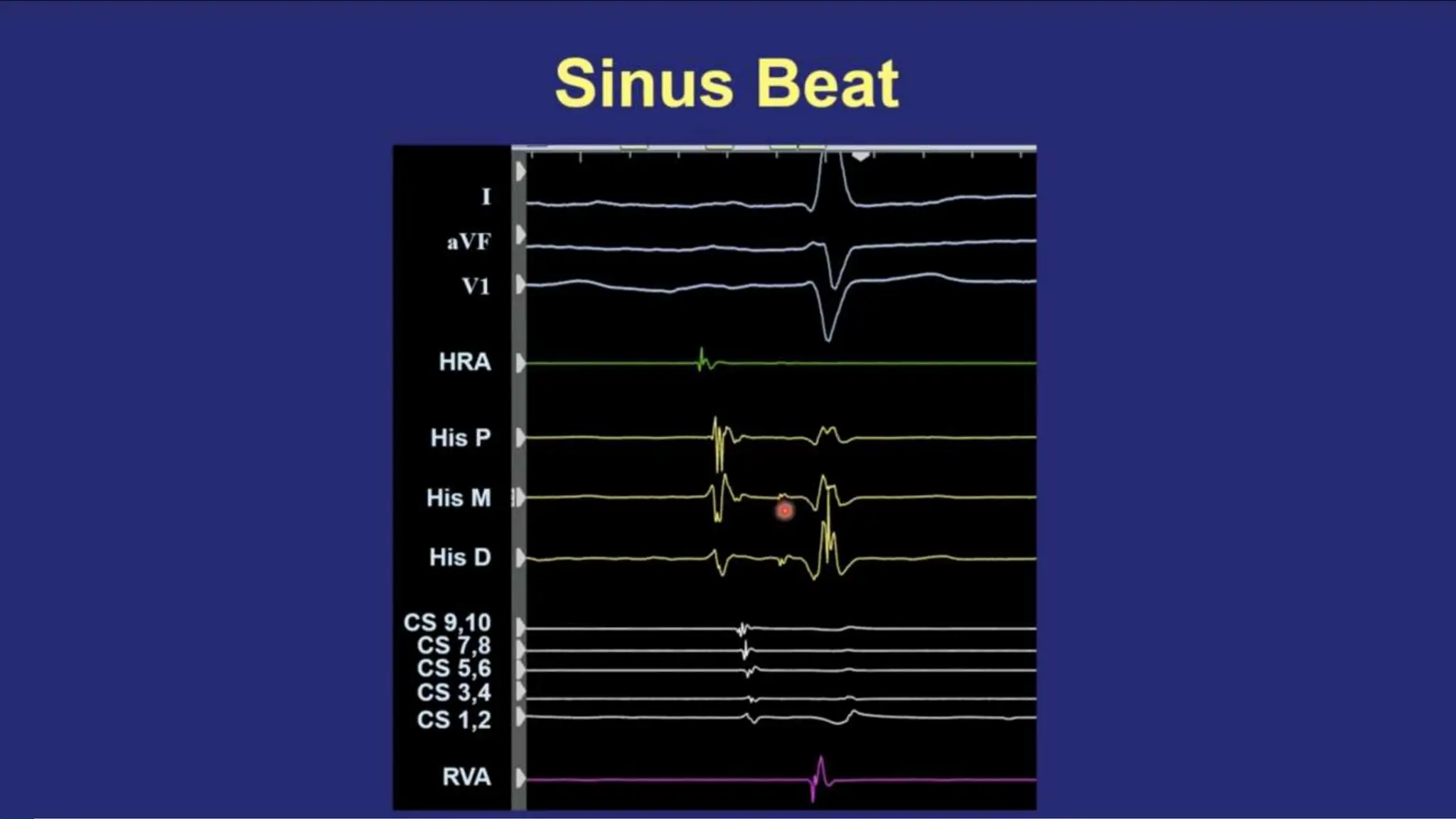 Basic Electrophysiology study and EGM material.pptx