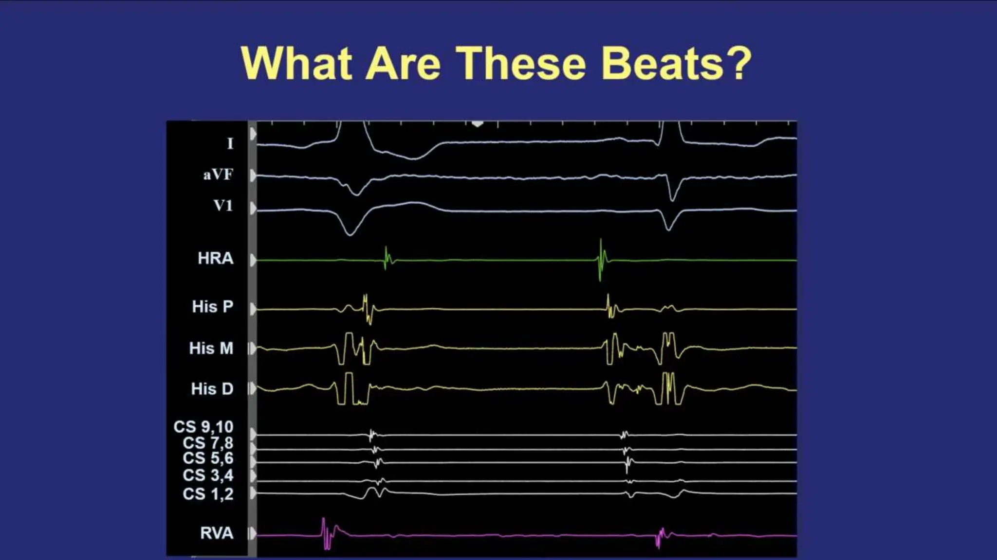 Basic Electrophysiology study and EGM material.pptx