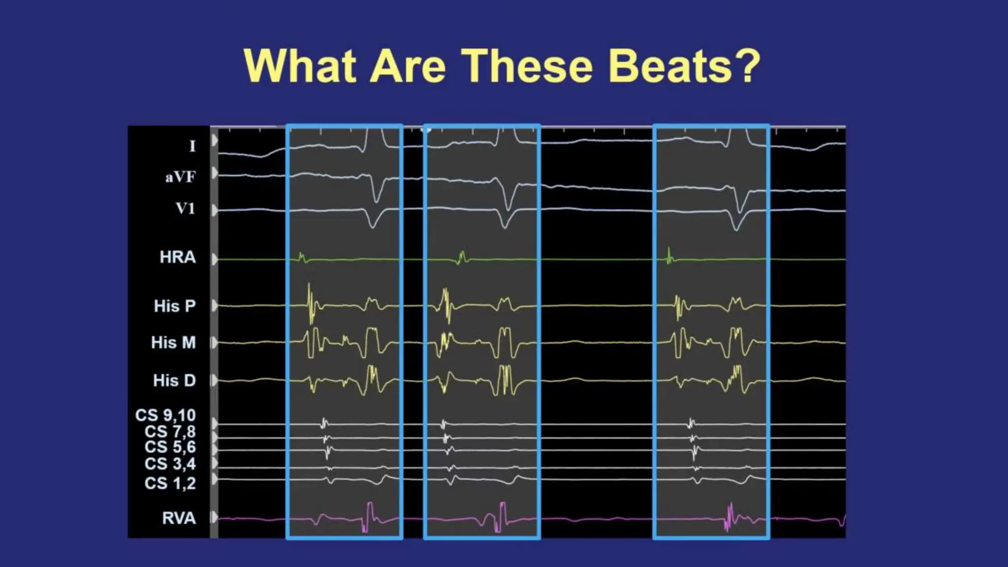 Basic Electrophysiology study and EGM material.pptx