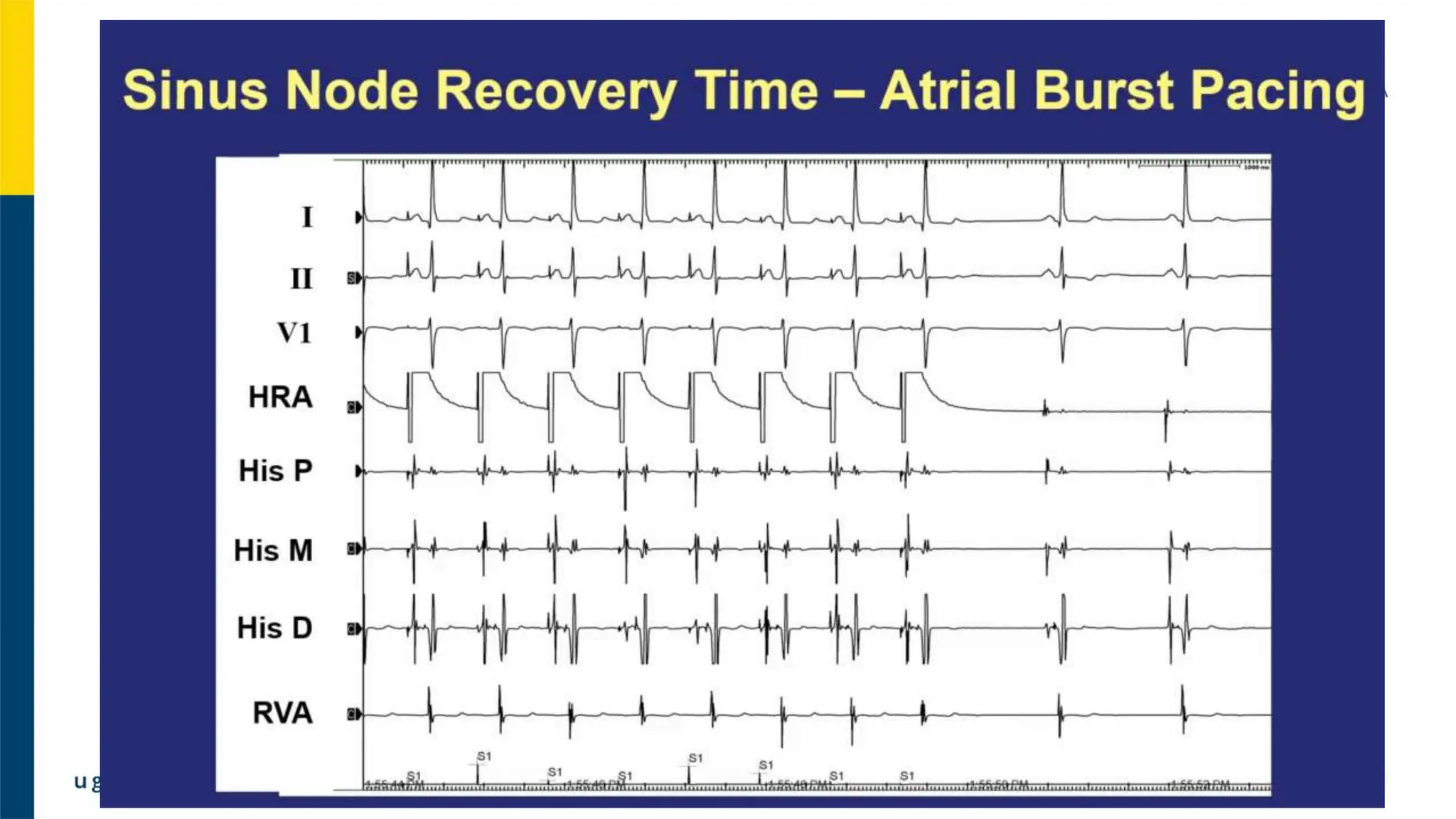 Basic Electrophysiology study and EGM material.pptx