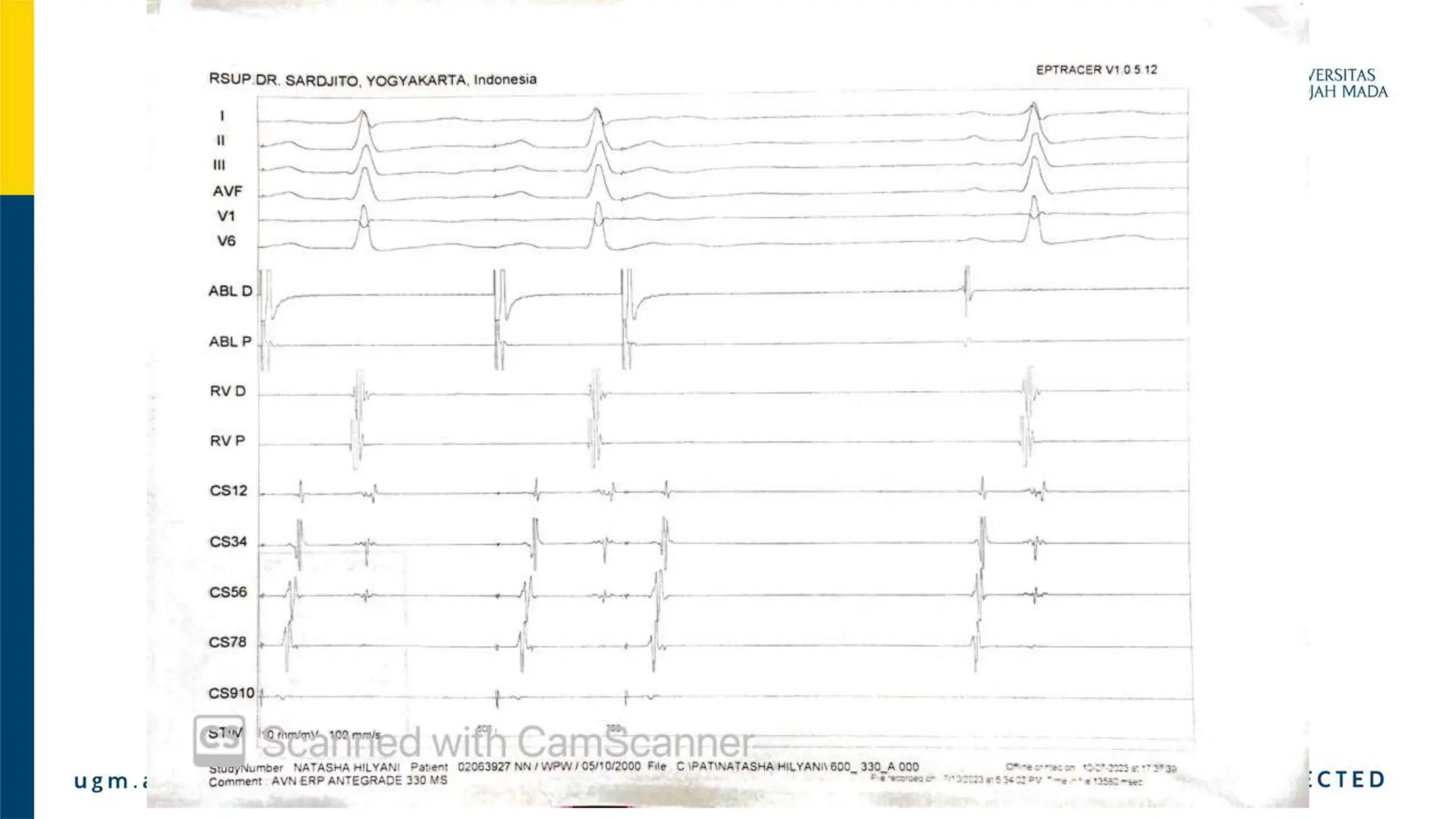 Basic Electrophysiology study and EGM material.pptx