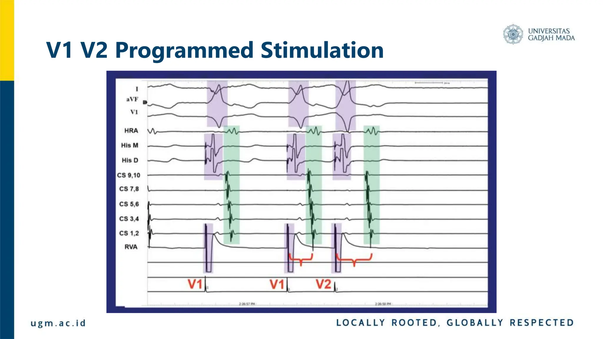 Basic Electrophysiology study and EGM material.pptx