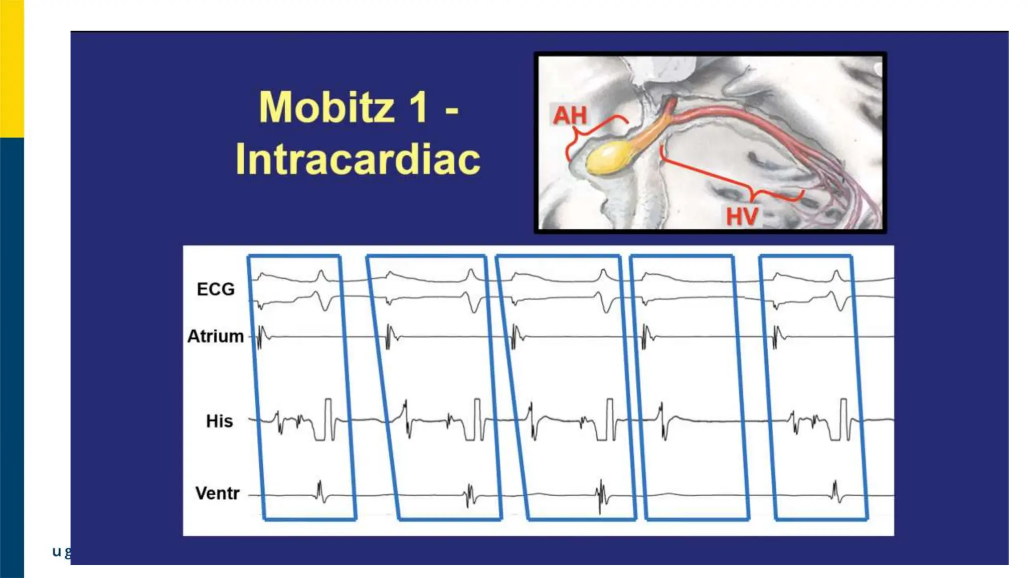 Basic Electrophysiology study and EGM material.pptx