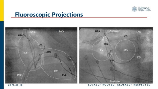 Basic Electrophysiology study and EGM material.pptx | Heart and ...