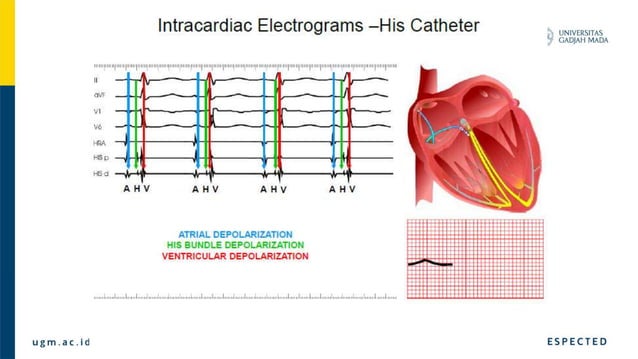 Basic Electrophysiology study and EGM material.pptx | Heart and ...