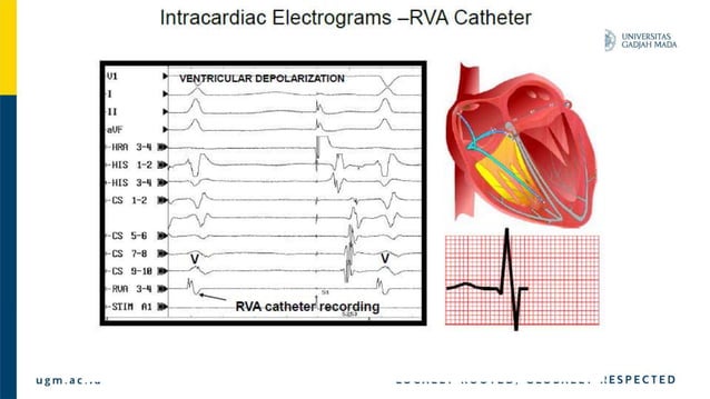 Basic Electrophysiology study and EGM material.pptx | Heart and ...