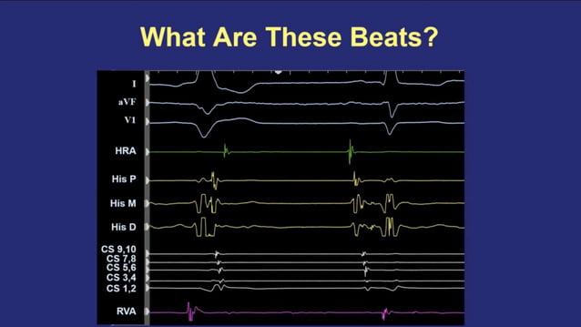 Basic Electrophysiology study and EGM material.pptx | Heart and ...