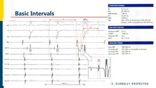 Basic Electrophysiology study and EGM material.pptx