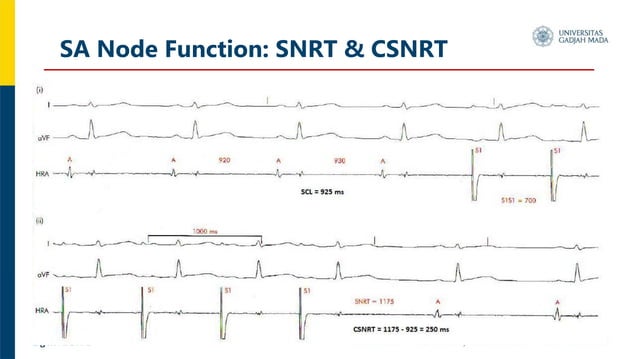 Basic Electrophysiology study and EGM material.pptx | Heart and ...