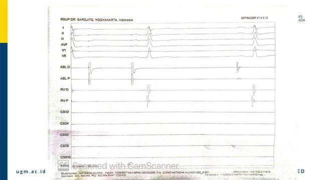 Basic Electrophysiology study and EGM material.pptx | Heart and ...