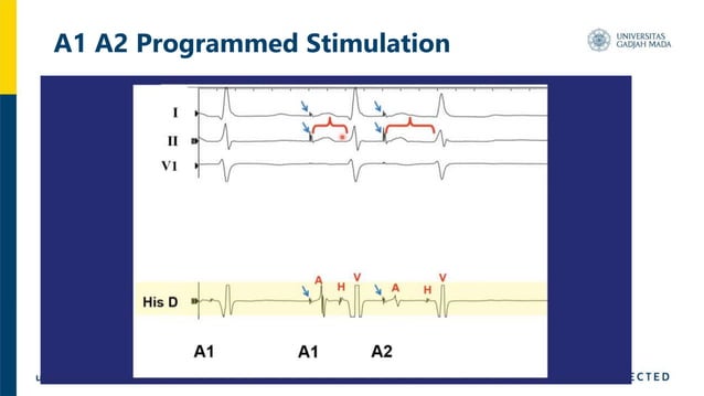 Basic Electrophysiology study and EGM material.pptx | Heart and ...