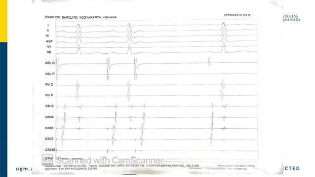 Basic Electrophysiology study and EGM material.pptx | Heart and ...