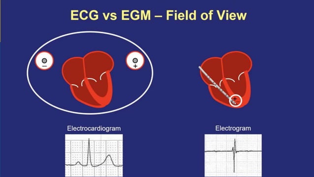 Basic Electrophysiology study and EGM material.pptx | Heart and ...