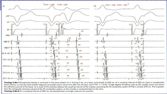 Basic EP study part 2 | PPT