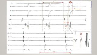 Basic EP study part 2 | PPTX
