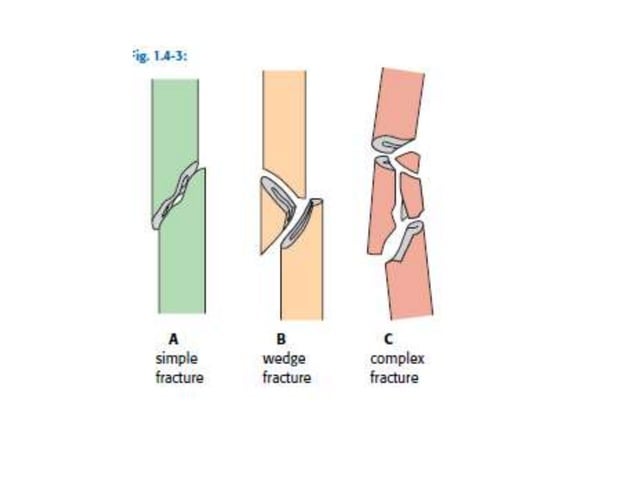 basic fracture management JUNE.pptx