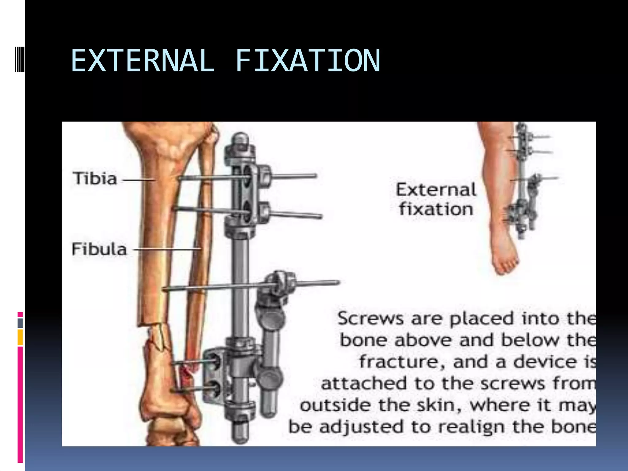 Basic fracture management | PPTX