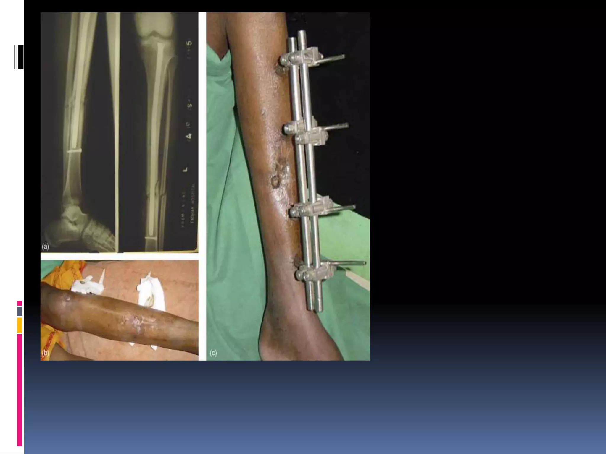 Basic fracture management | PPTX