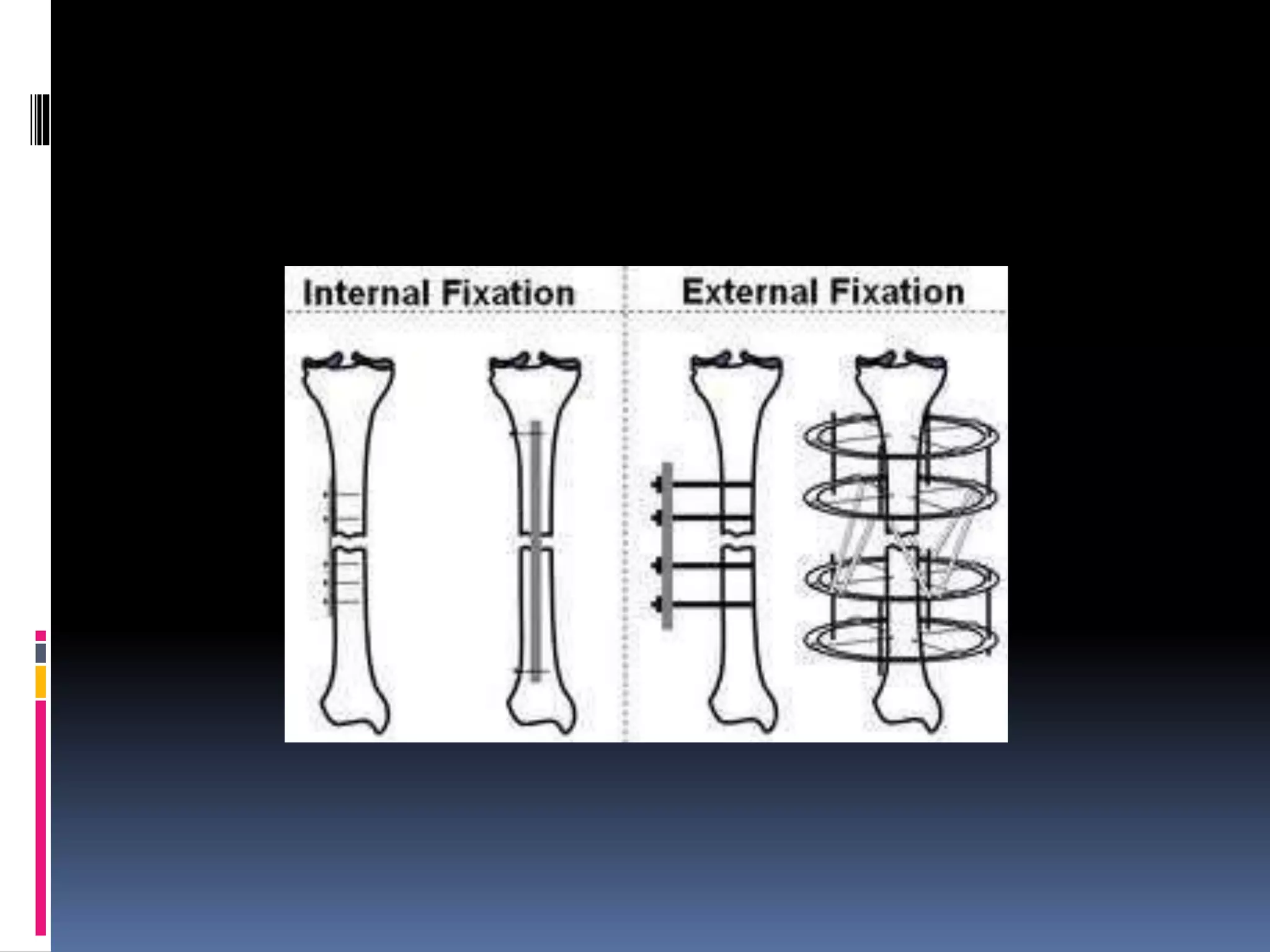 Basic fracture management | PPTX