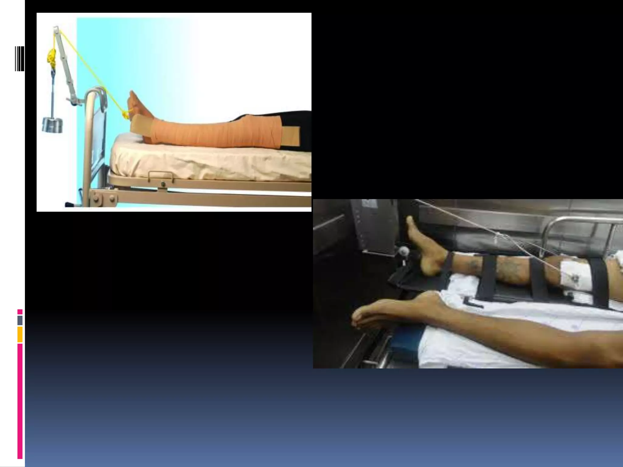 Basic fracture management | PPTX