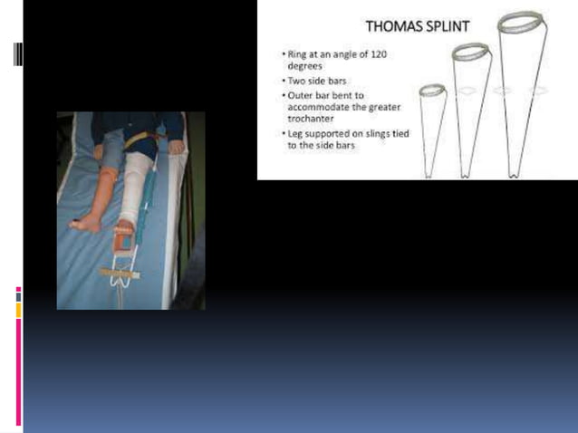 Basic fracture management | PPTX