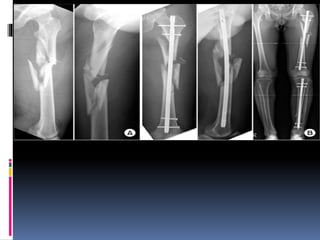 Basic fracture management | PPTX