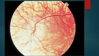 Basic fundoscopy | PPTX