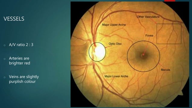 Basic fundoscopy | PPTX | Eye and Vision Conditions | Diseases and ...