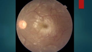 Basic fundoscopy | PPTX