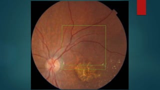 Basic fundoscopy | PPTX