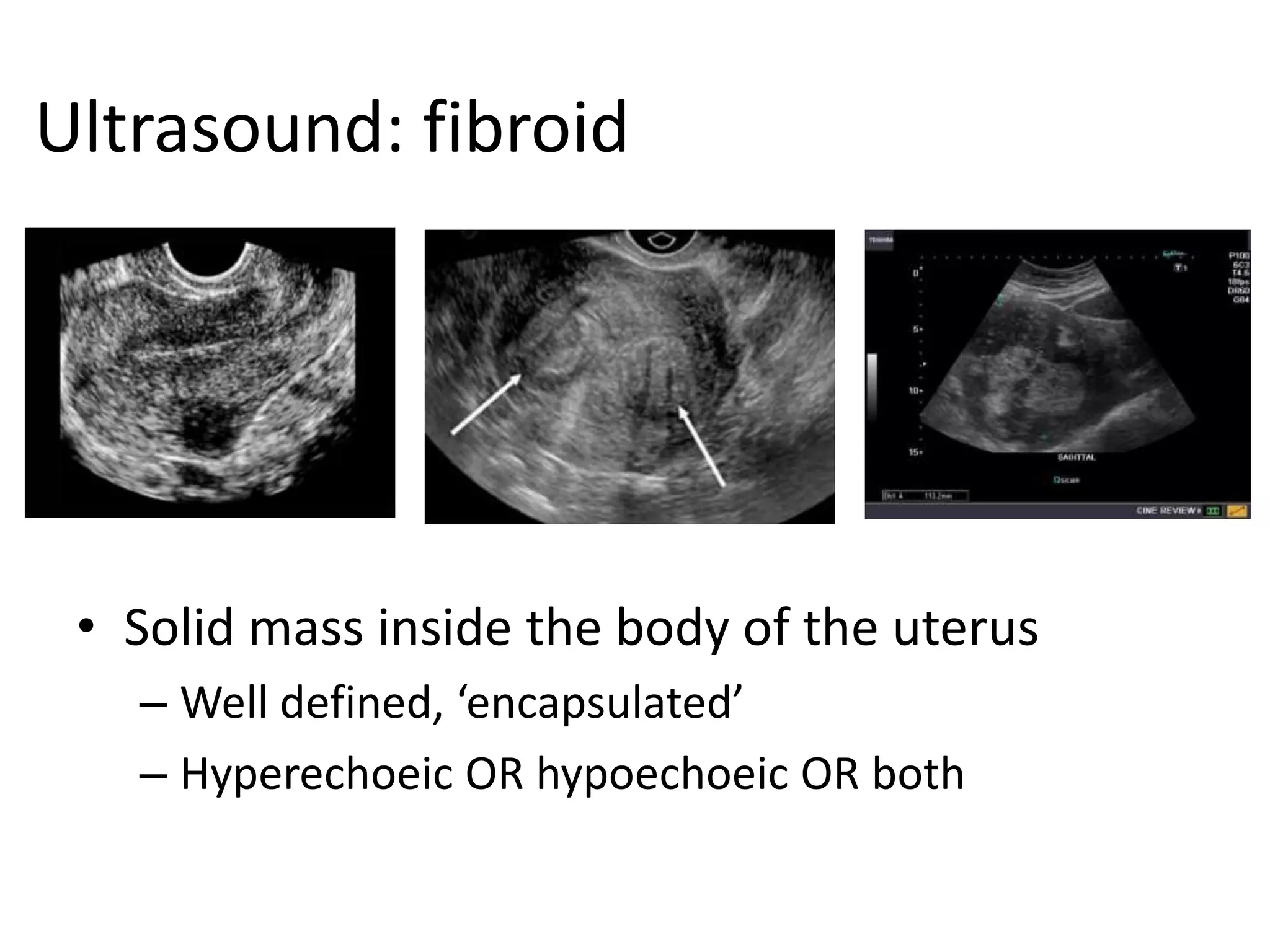 Basic gynae ultrasound | PPTX
