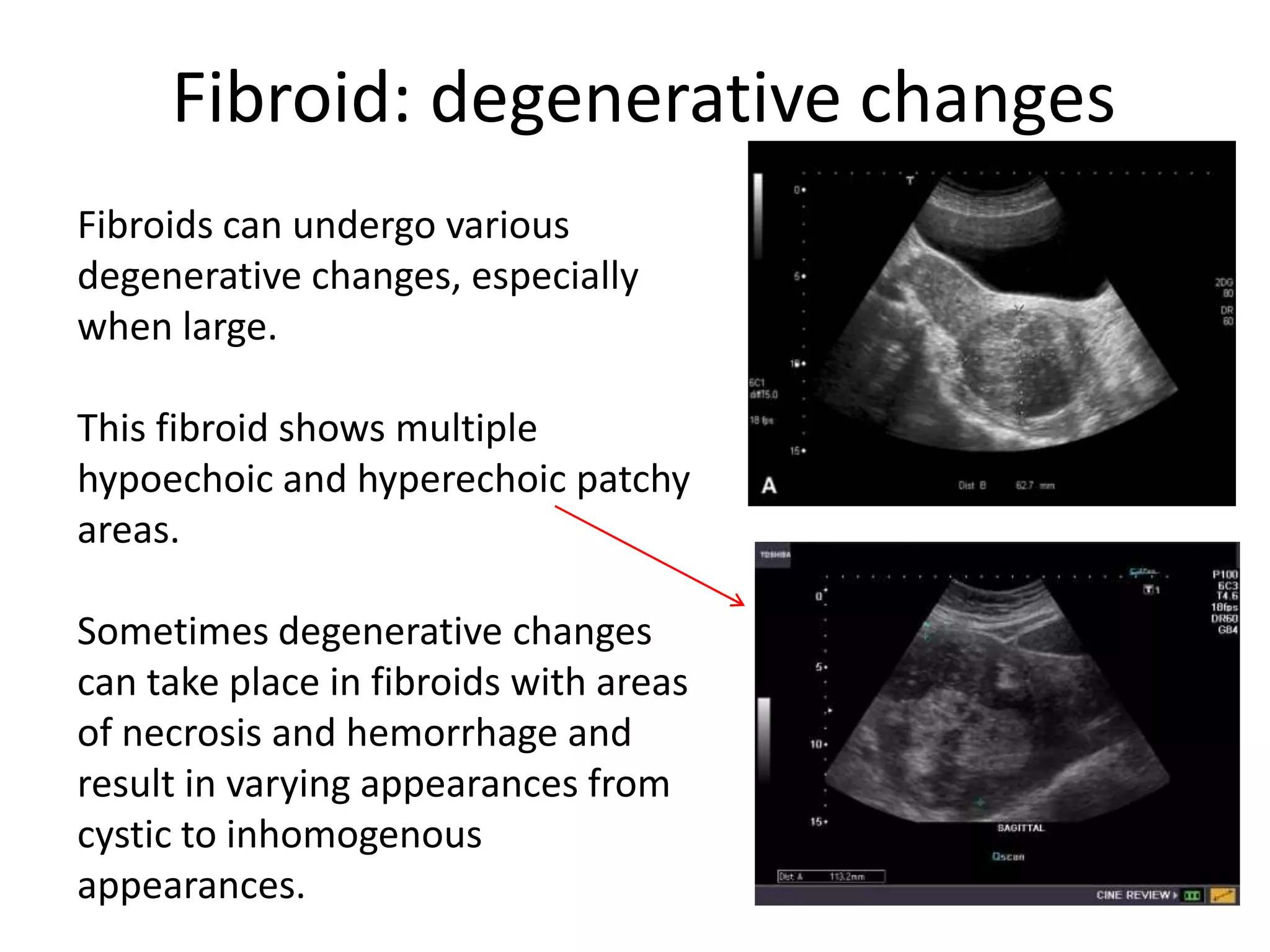 Basic gynae ultrasound | PPTX