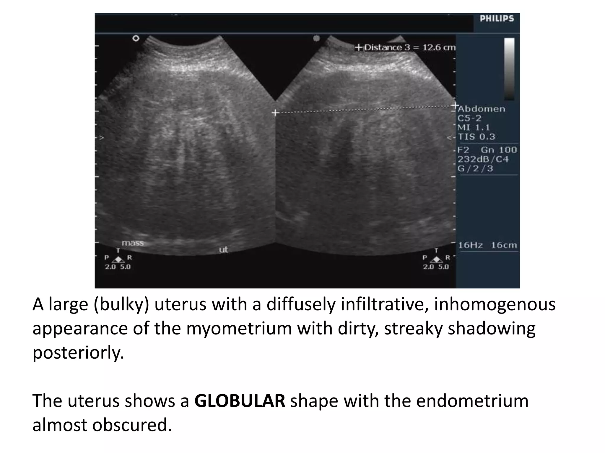 Basic gynae ultrasound | PPTX