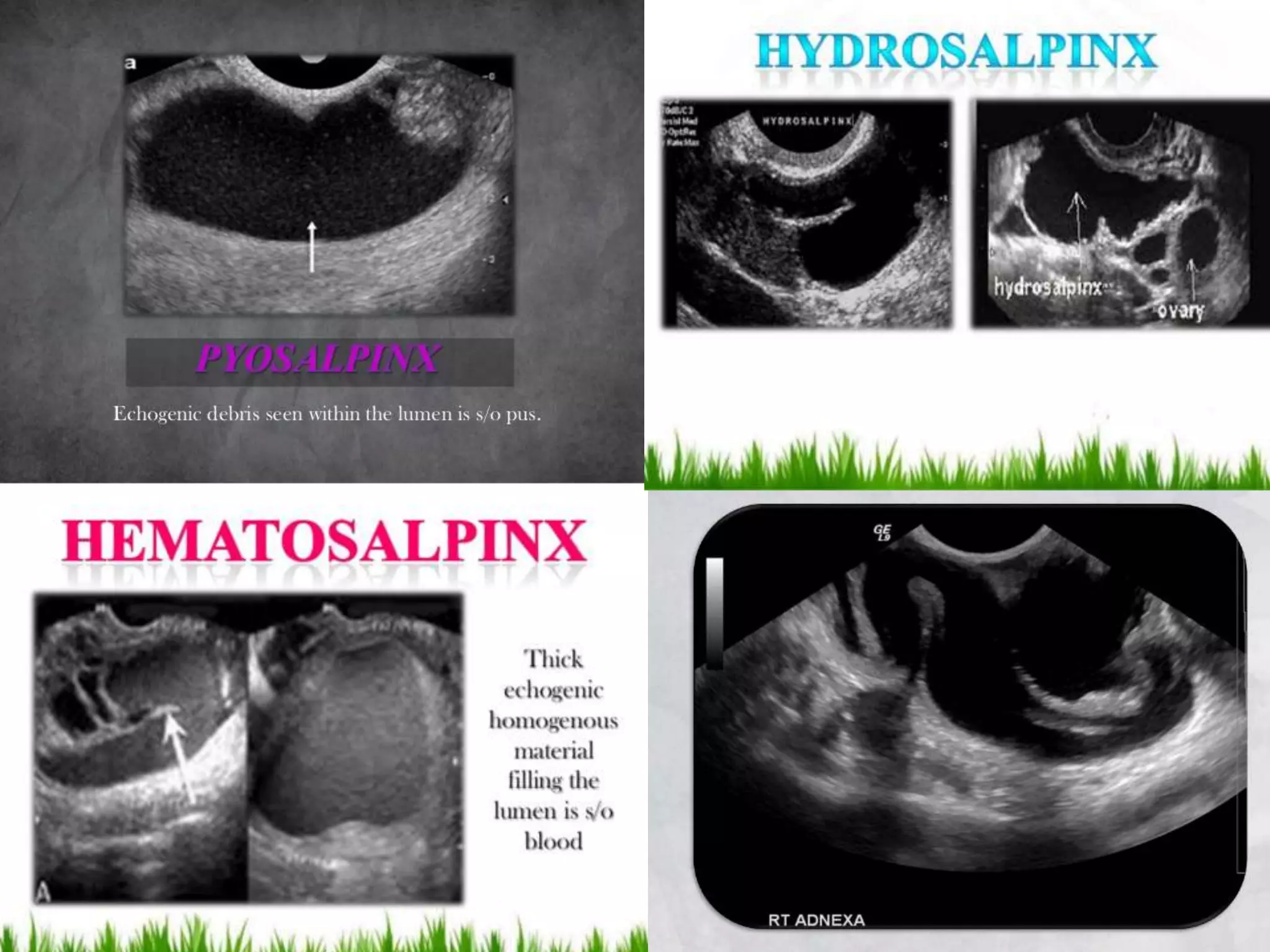 Basic gynae ultrasound | PPTX