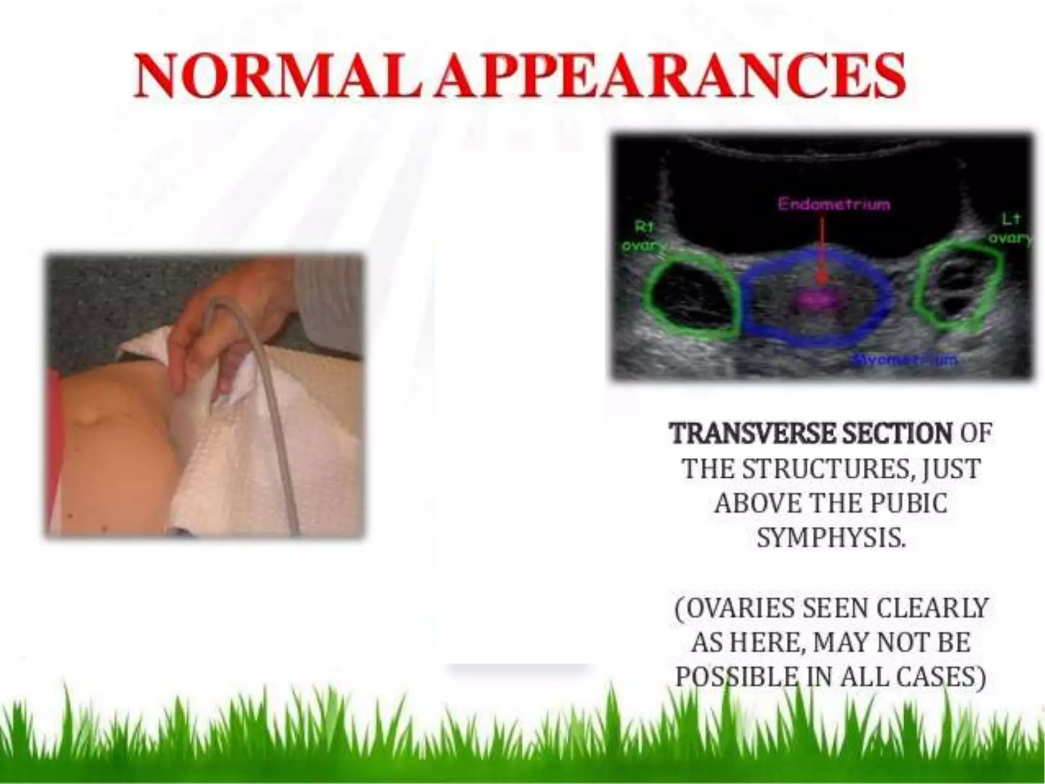 Basic gynae ultrasound | PPTX
