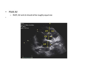 Basic haemodynamic assessment with echo (iHeartScan) | PPTX