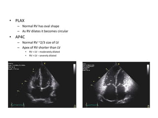 Basic haemodynamic assessment with echo (iHeartScan) | PPTX