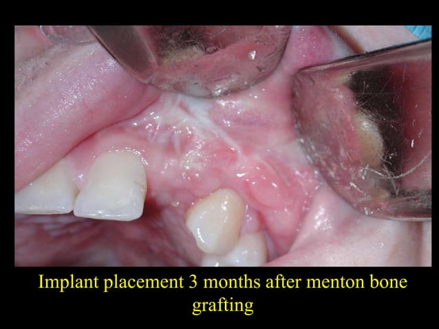 Basic implantology (periodontology and implantology) | PPT | Dental ...