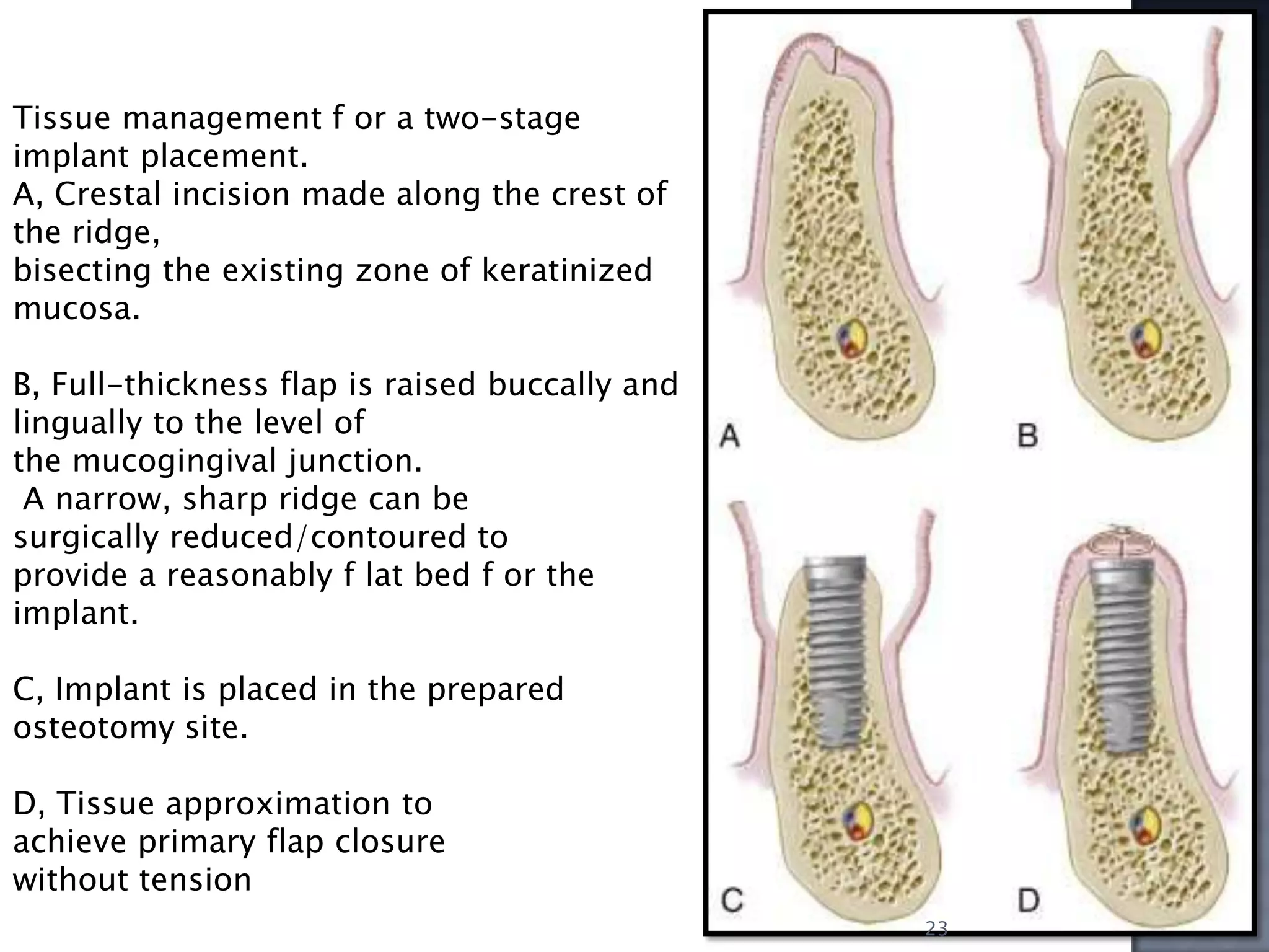 Basic implant surgery | PPTX