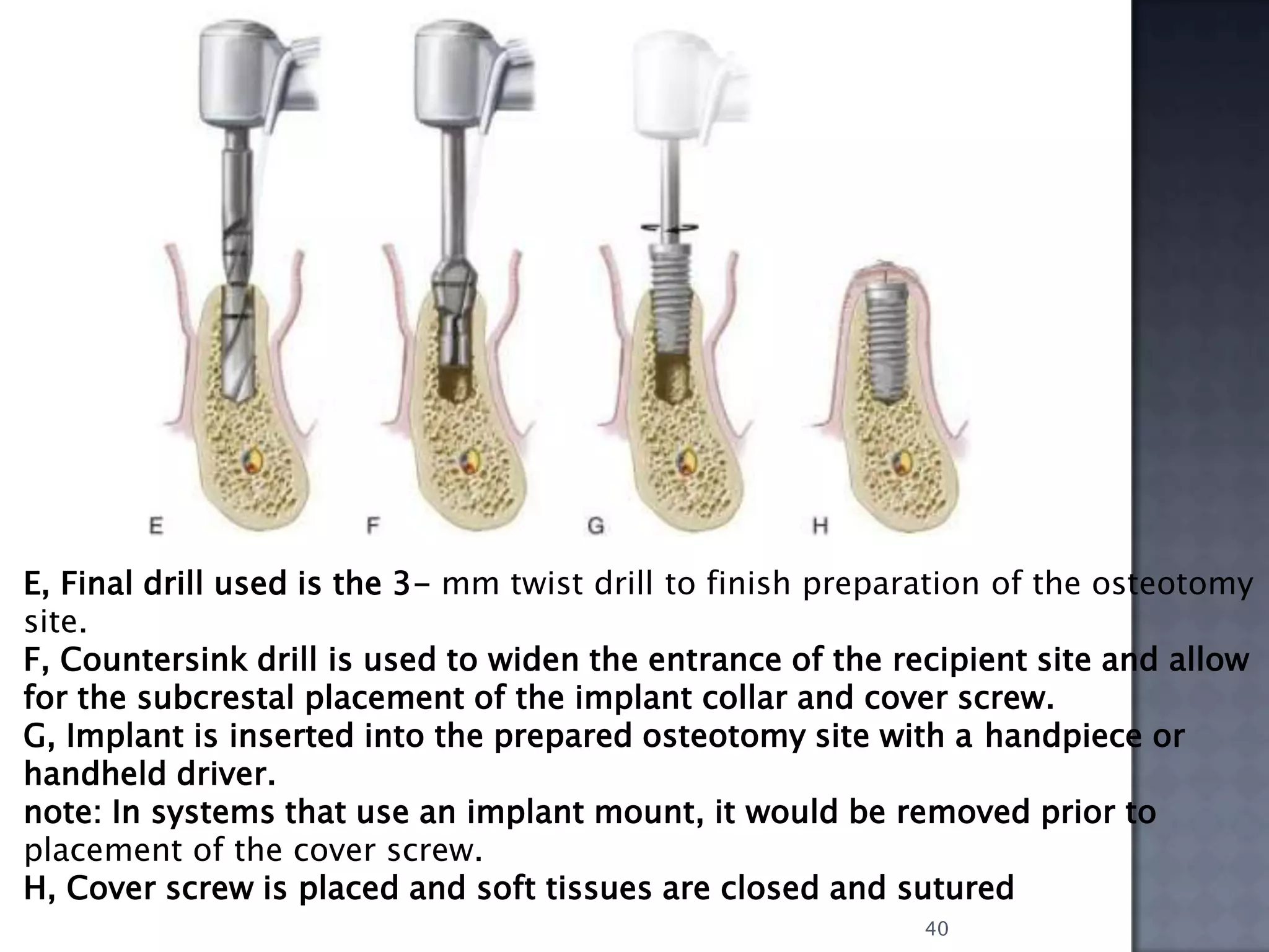 Basic implant surgery | PPTX
