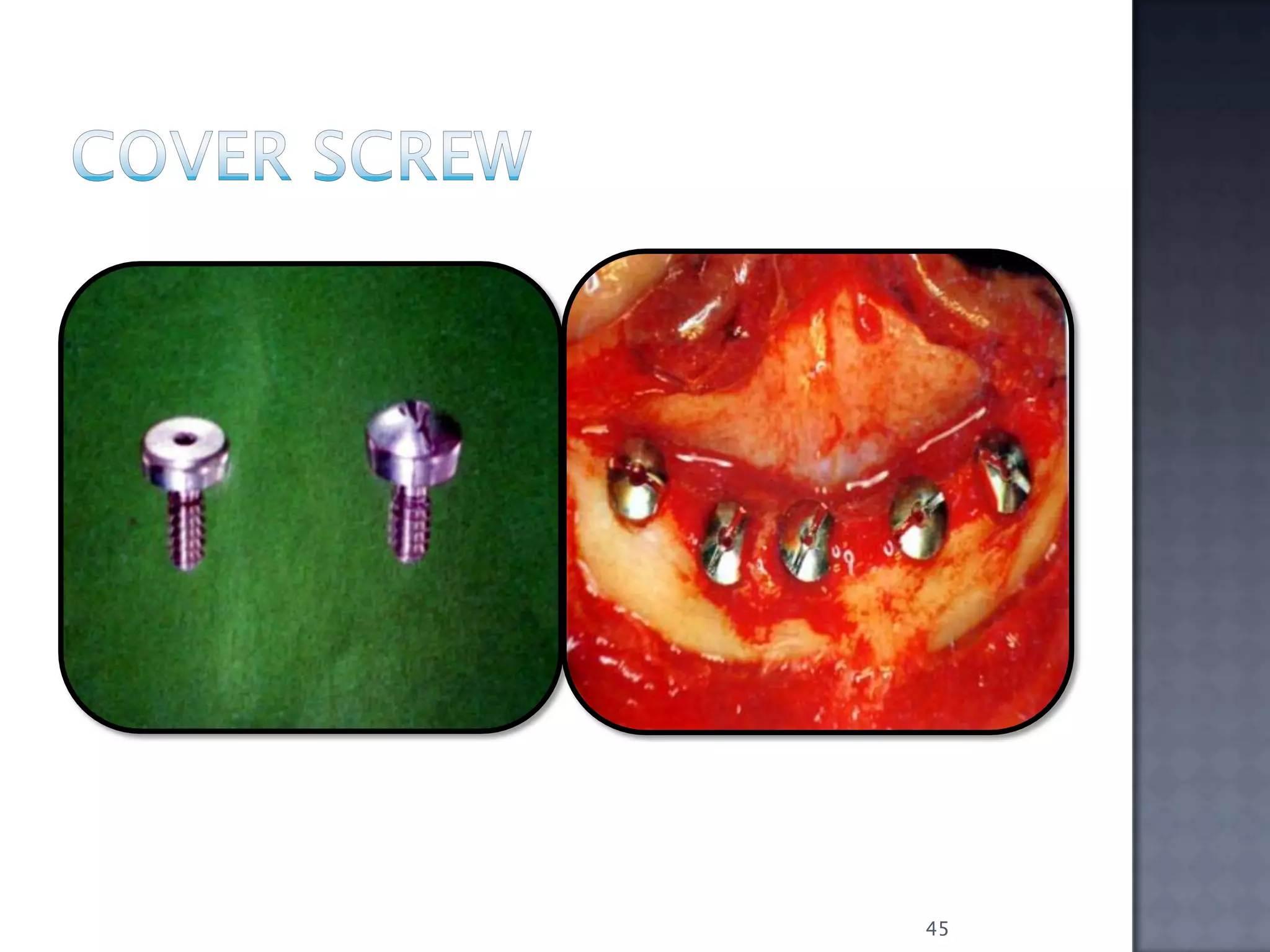 Basic implant surgery | PPTX