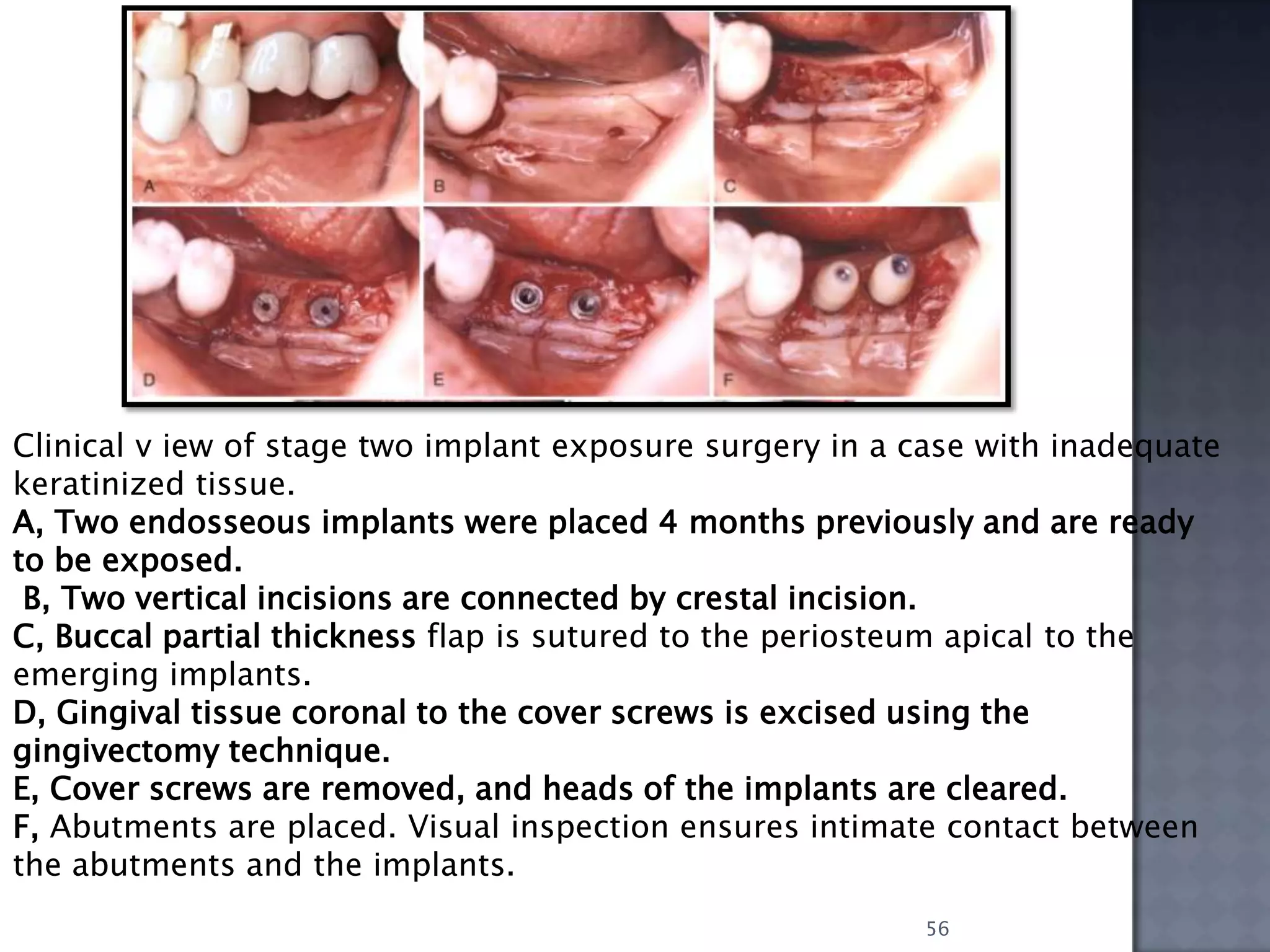 Basic implant surgery | PPTX