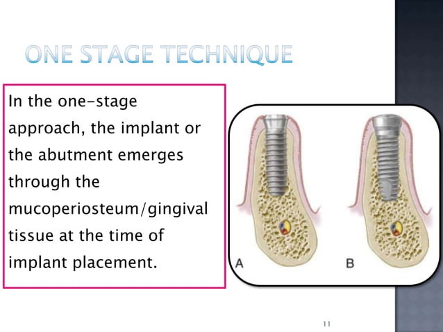 Basic implant surgery | PPTX
