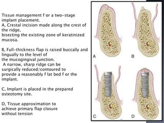 Basic implant surgery | PPTX