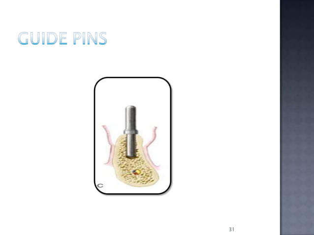 Basic implant surgery | PPTX