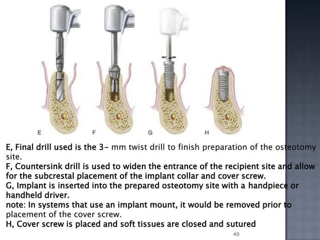 Basic implant surgery | PPTX