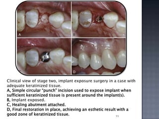 Basic implant surgery | PPTX